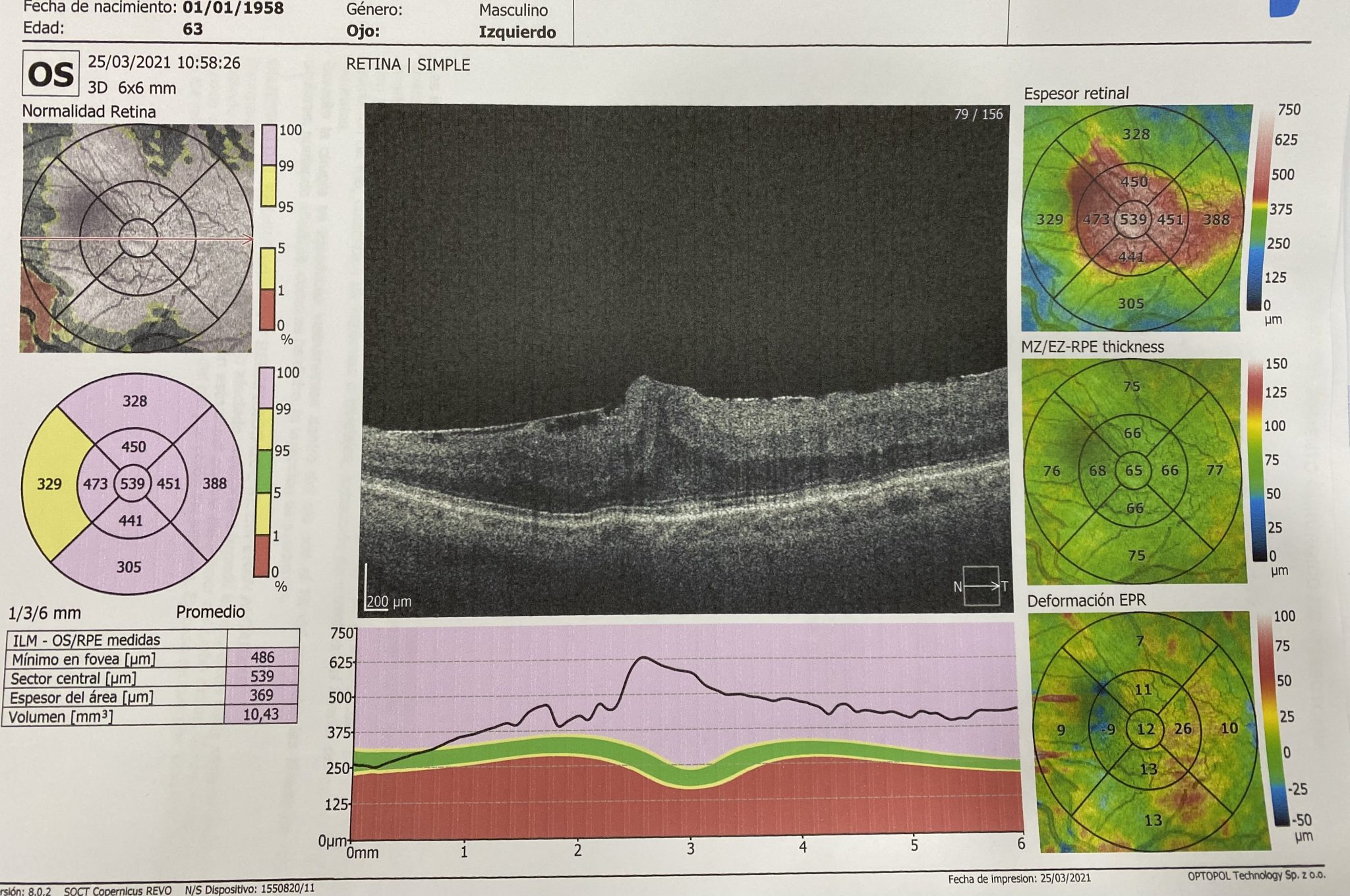 Desprendimiento de Retina - Clinica Sagrario